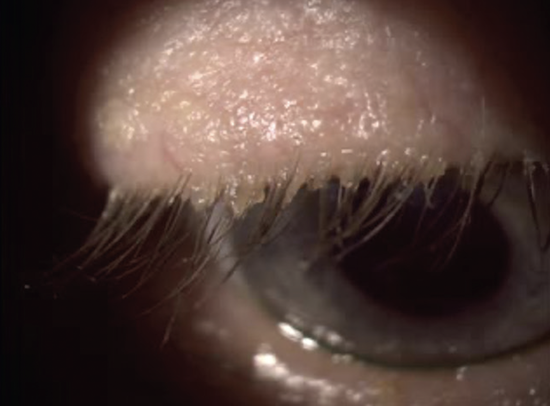 Demodex: Friend or Foe?