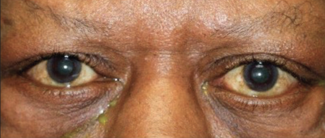 Autoimmune Disease and the Eye