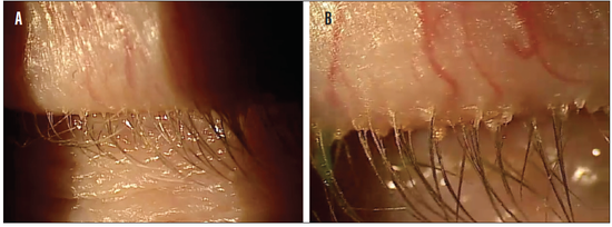 Dry Eye ... in Children?