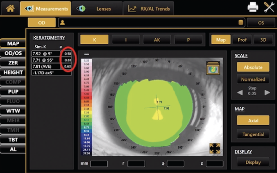 Elevating Your Orthokeratology Fitting Using Topograph...