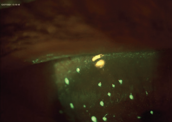 Sjögren Syndrome: Ocular Manifestations of an Underlyi...