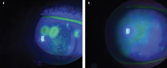 A Double-Header: Dry Eye and Filamentary Keratitis