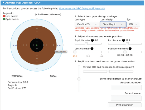 New Improvements in Multifocal Scleral Lens Technology