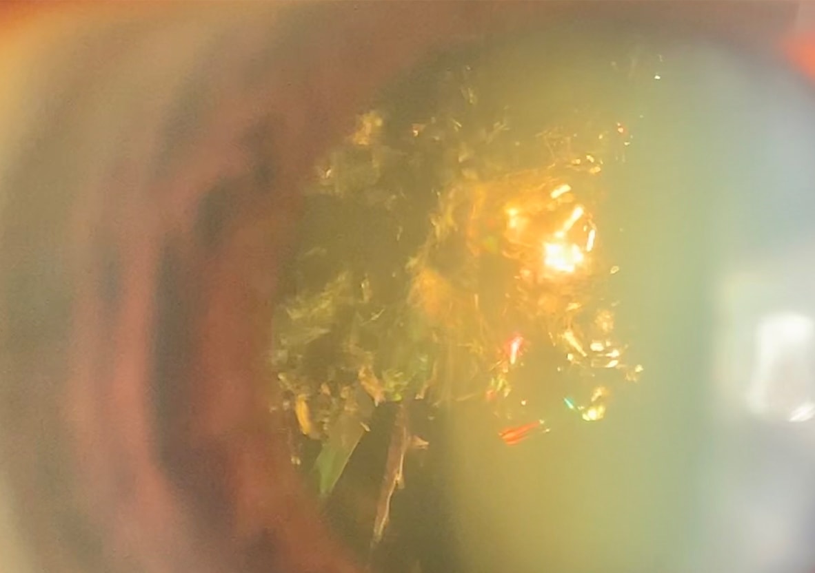 Christmas Tree Cataract