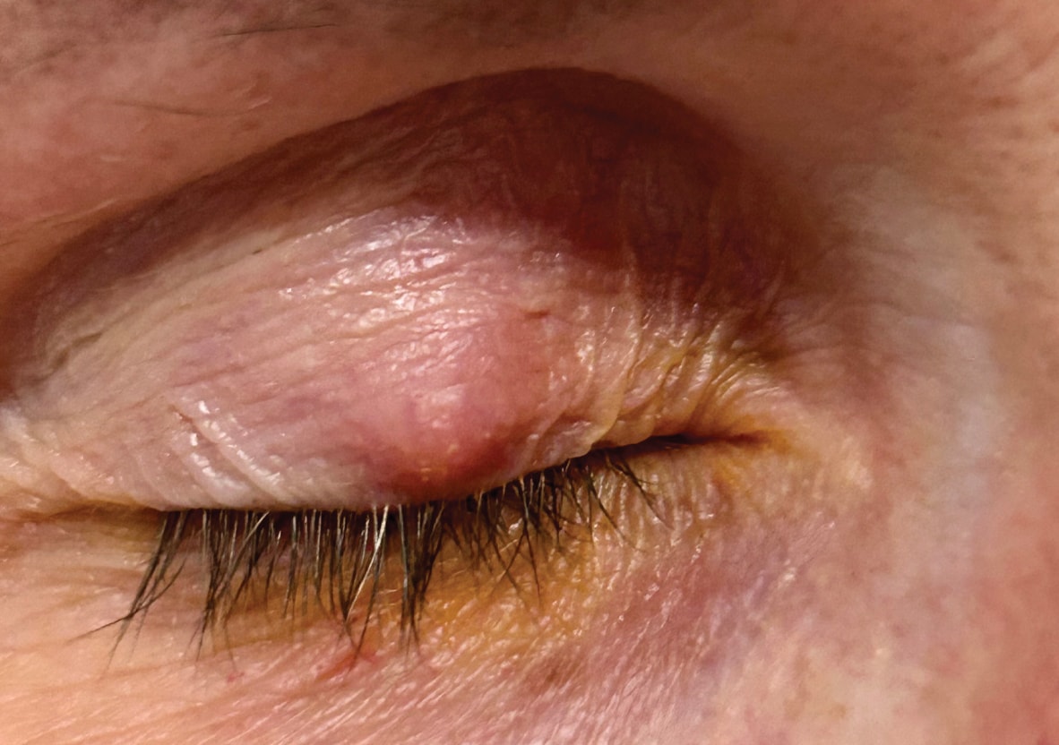 Don’t “Lump” All Lid Lesions Together