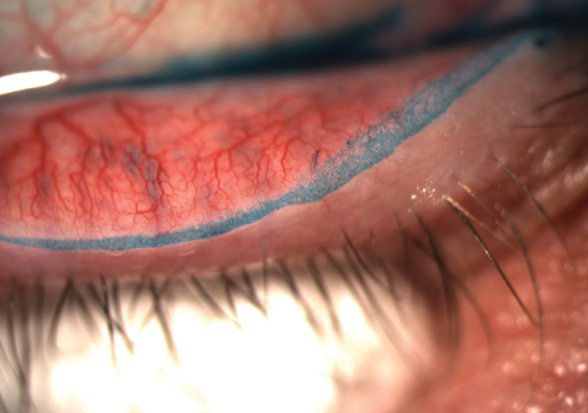 Putting a Lid on Epitheliopathy