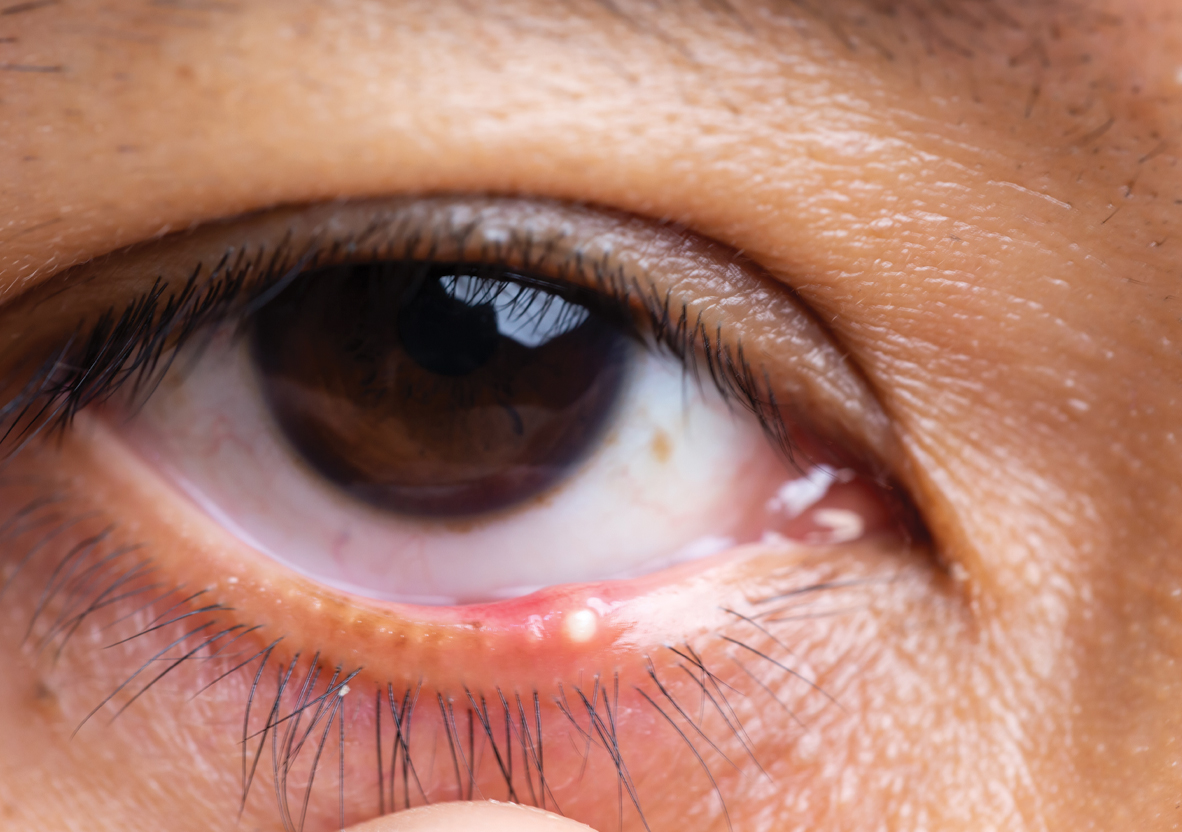 Understanding MGD Through the Lens of Sebaceous Gland ... -