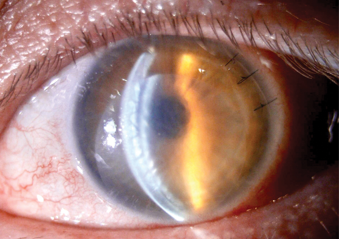 Corneal Endothelial Disease Intervention