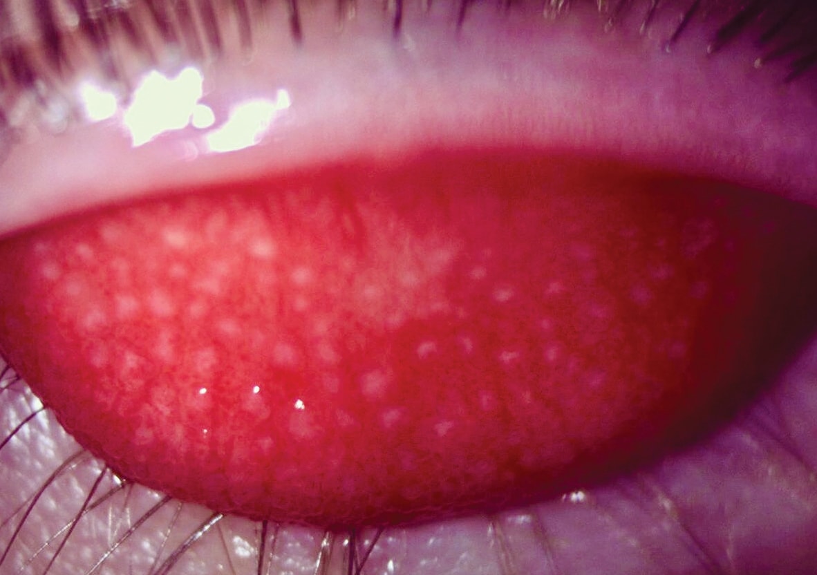 Giant Papillary Conjunctivitis: Diagnostic Pearls