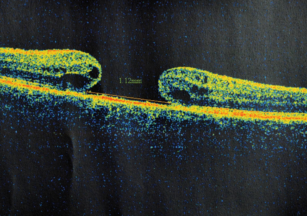 Know Your Vitreomacular Interface Disorders