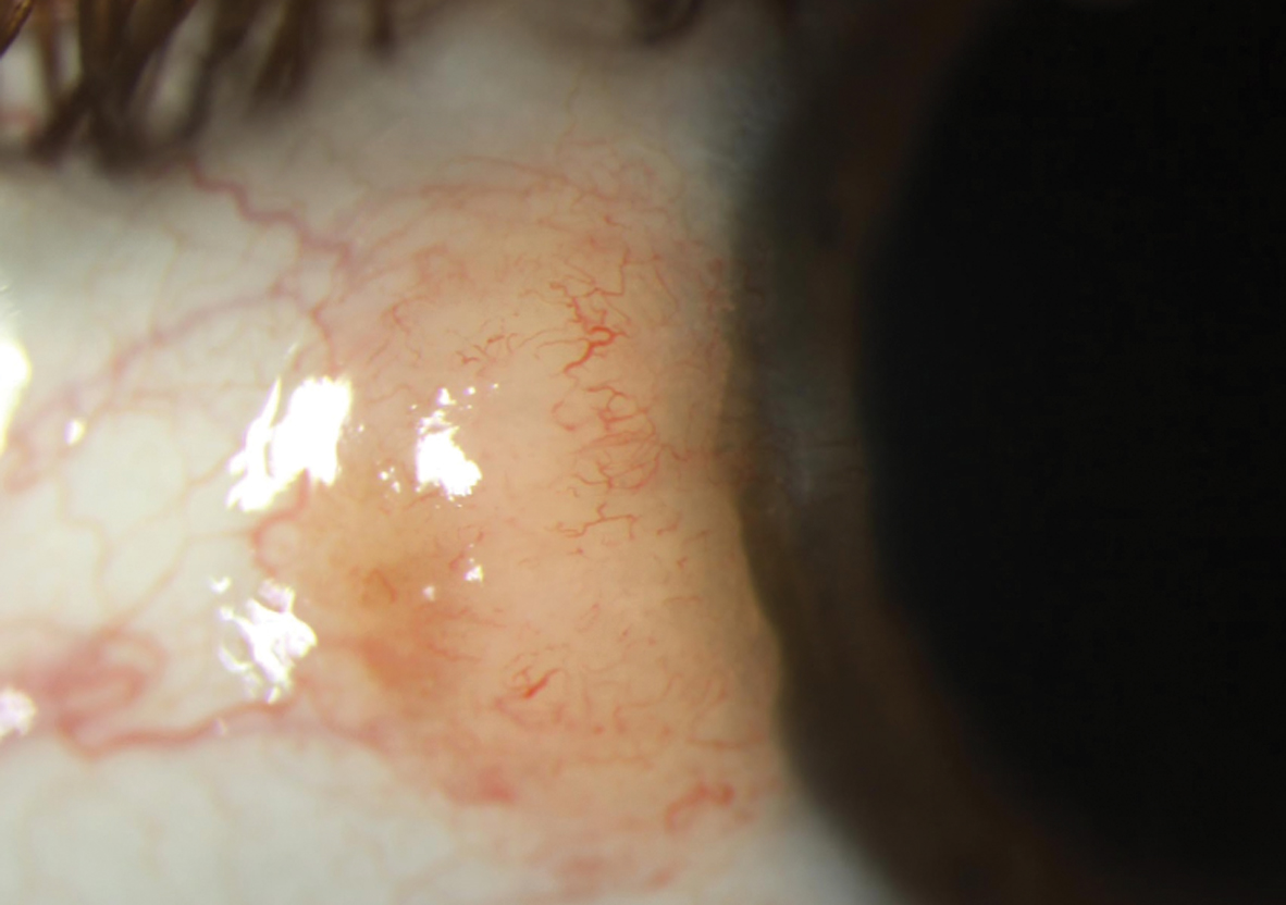 Performing an “Optical Biopsy” With HR-OCT