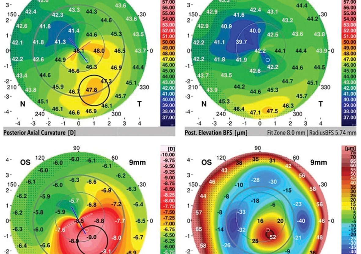 The Art and Science of Managing Post-LASIK Keratectasia