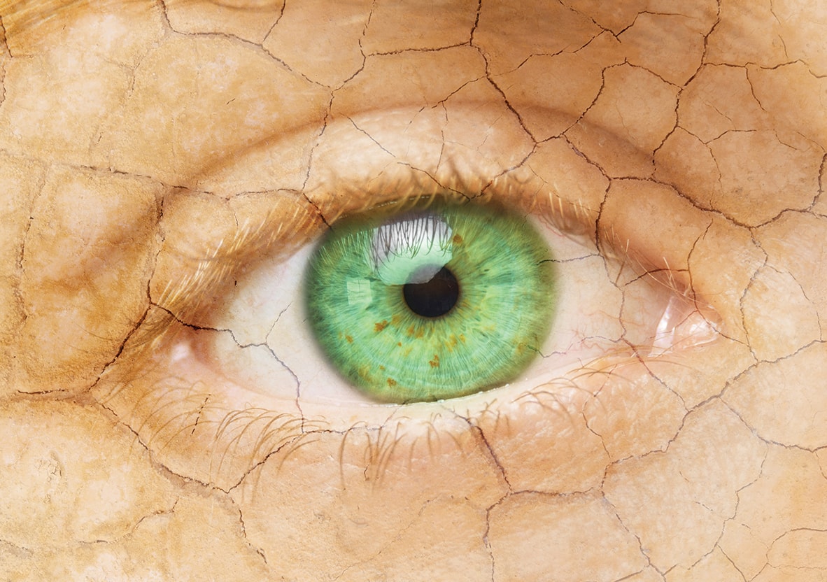 Use of Scleral Lenses For Dry Eye Disease