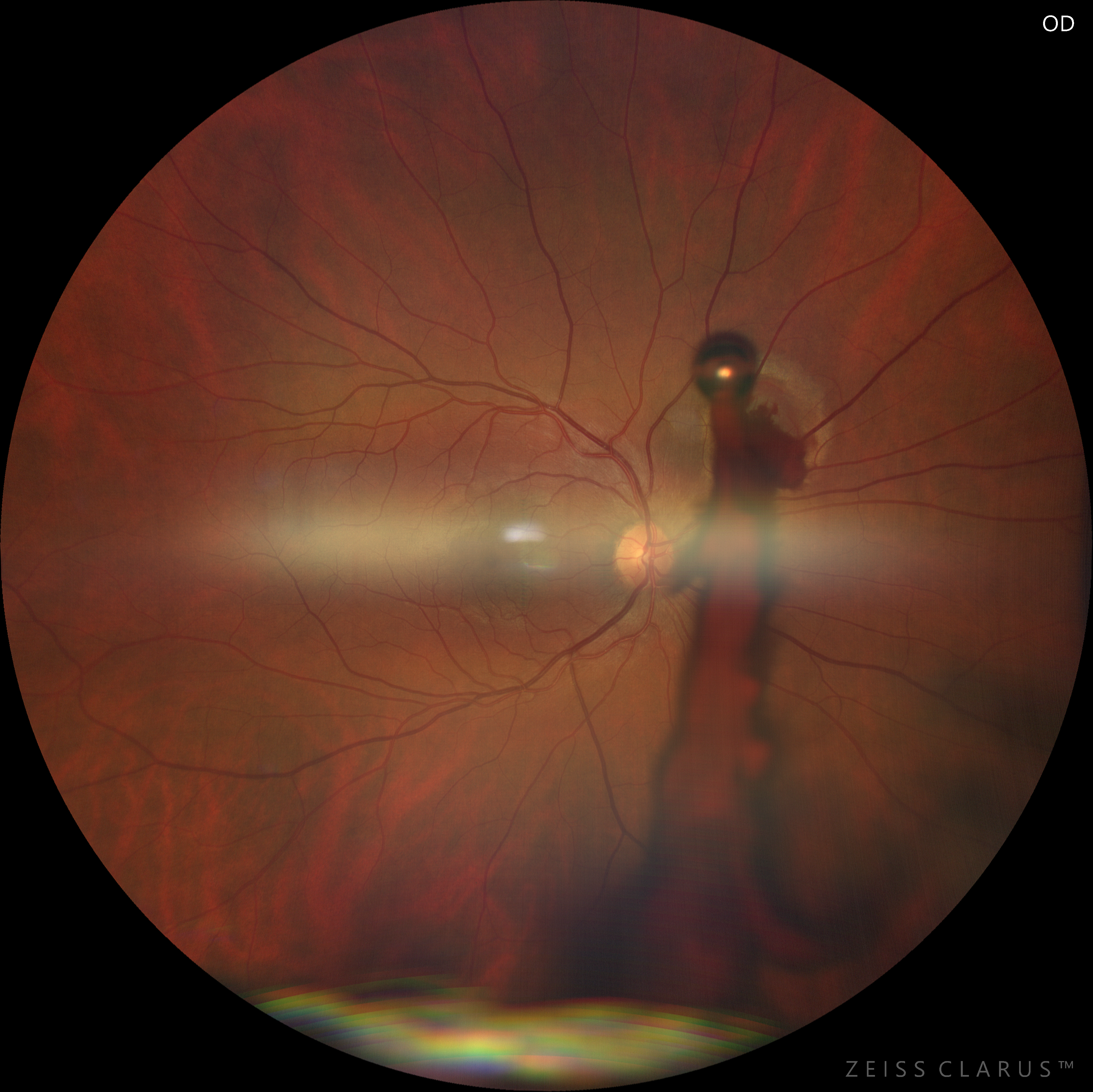 A Sneaky Sliver of Metal - Modern Optometry