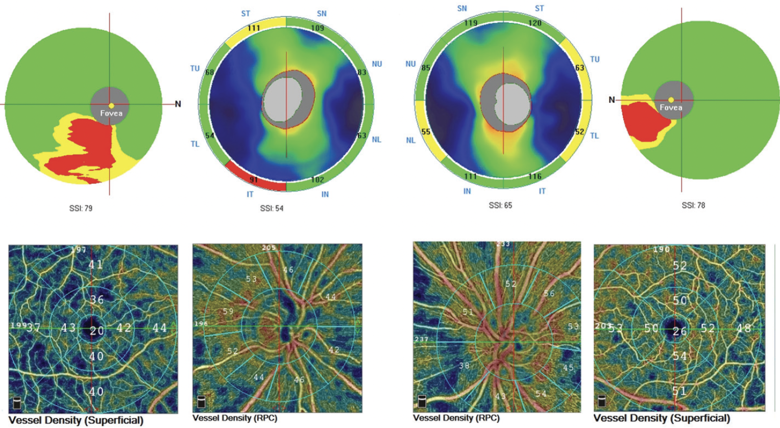 Practical Insights on OCTA in Glaucoma