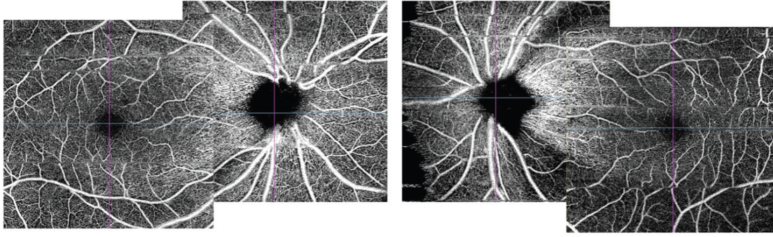 Practical Insights on OCTA in Glaucoma