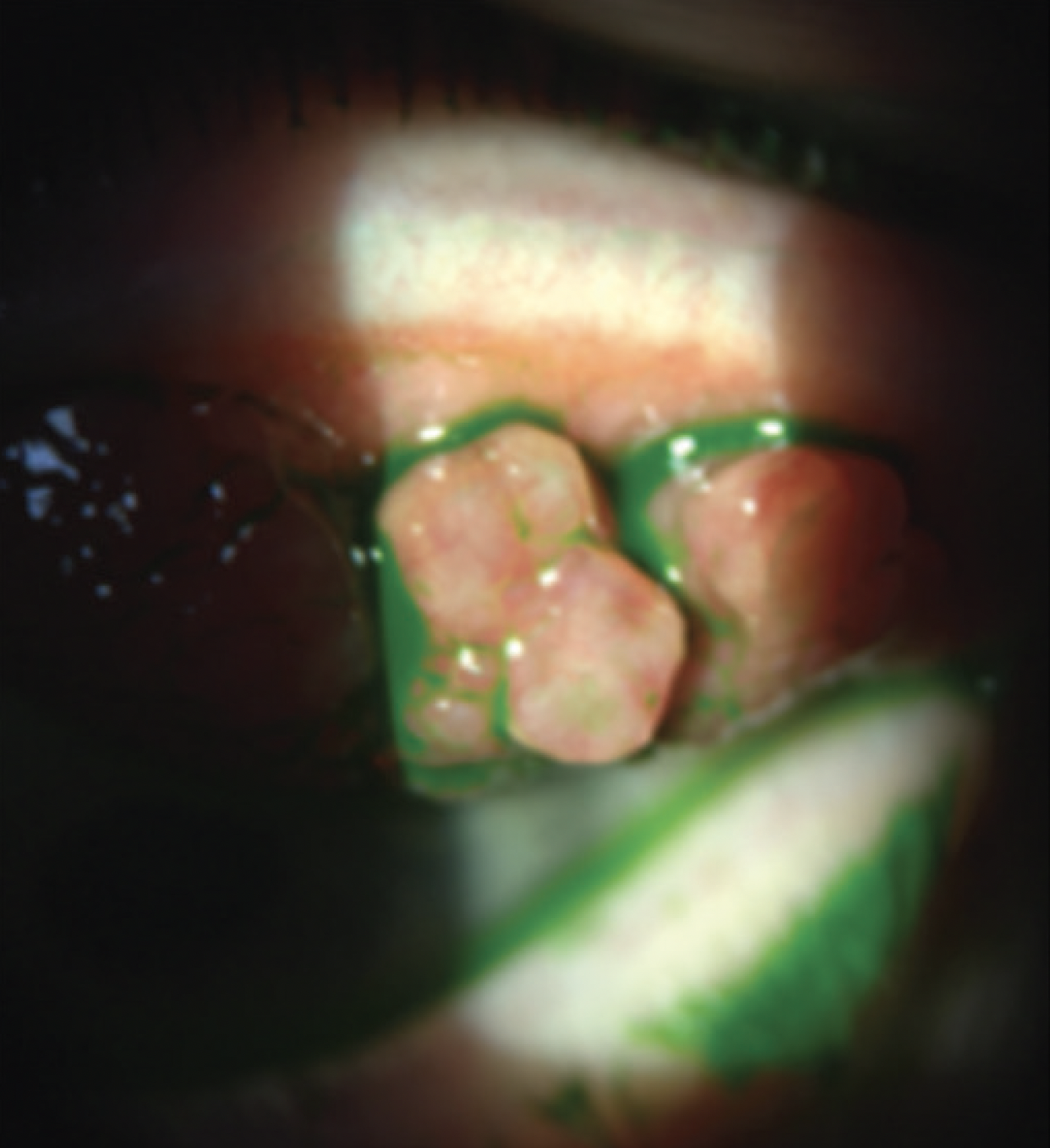 Scleral Lens Fitting Tips and Tricks