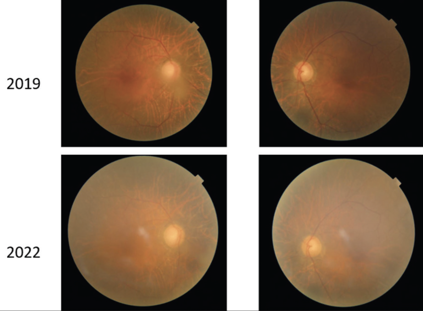 Spiculated Speculation: When RP and Glaucoma Collide