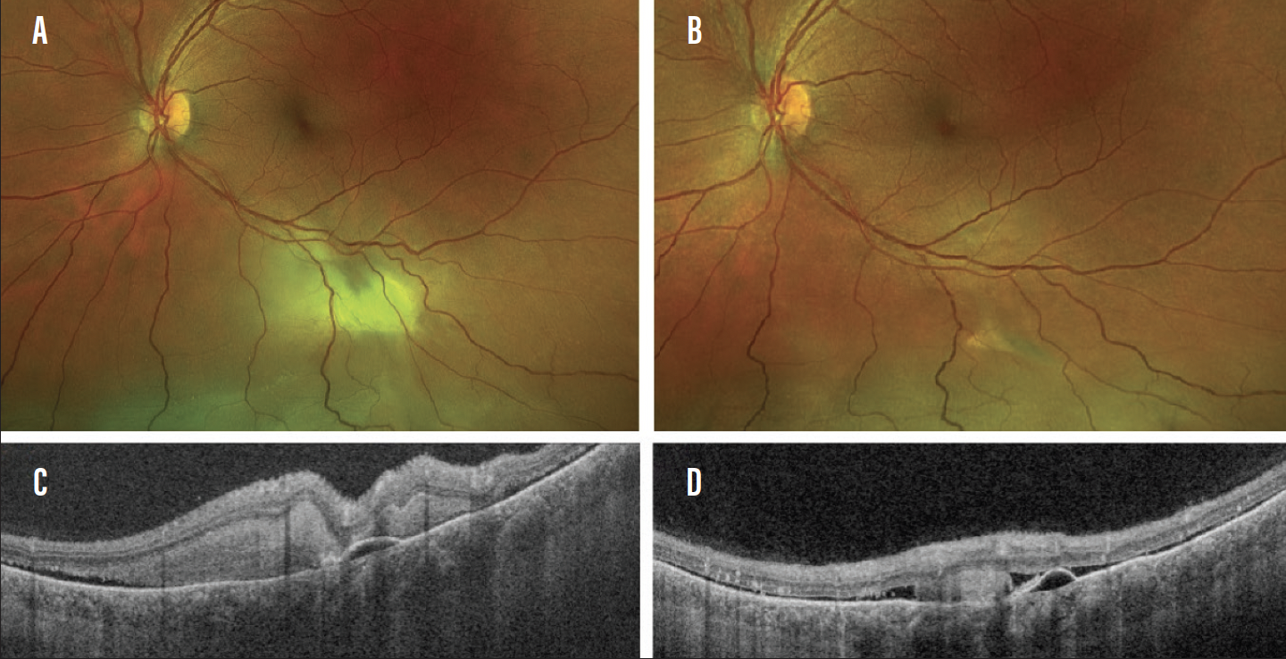 Understanding Ocular Metastatic Tumors and Simulating ... -