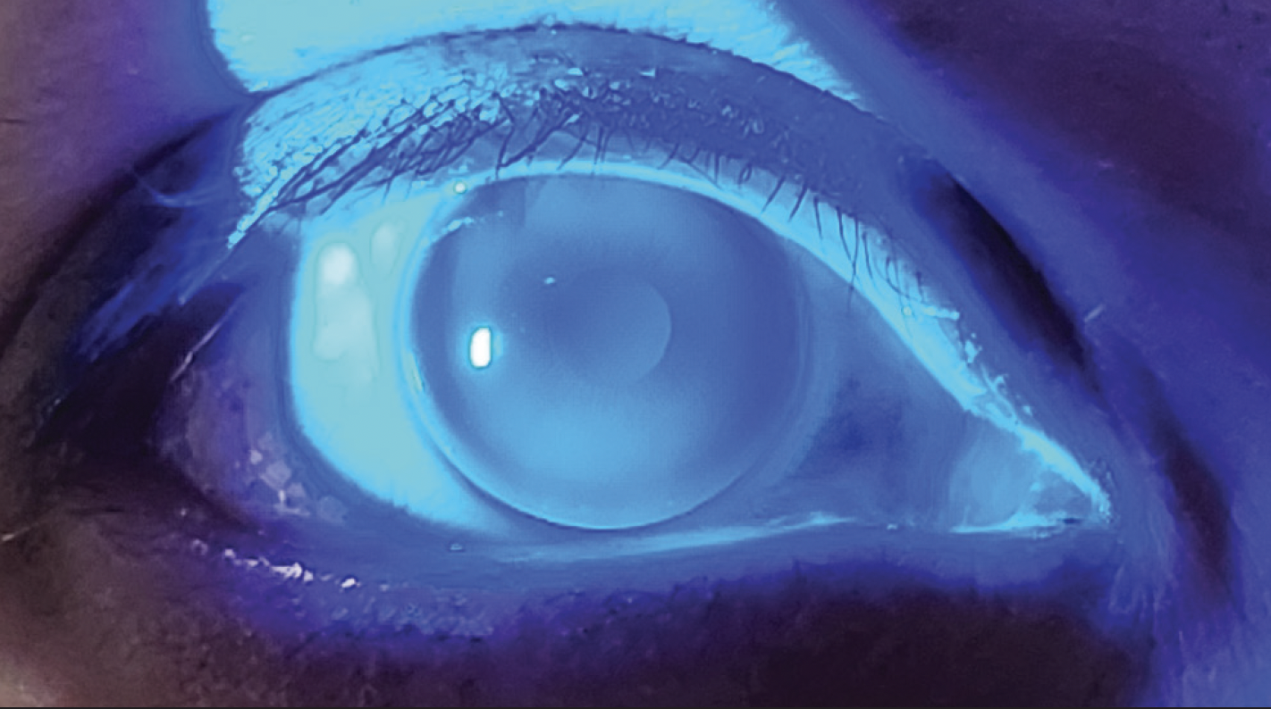 The Art and Science of Managing Post-LASIK Keratectasia