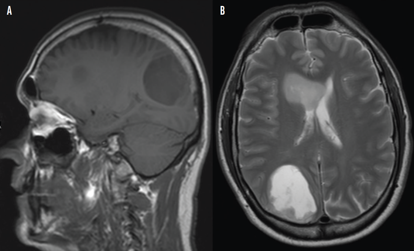 Glioblastoma Multiforme