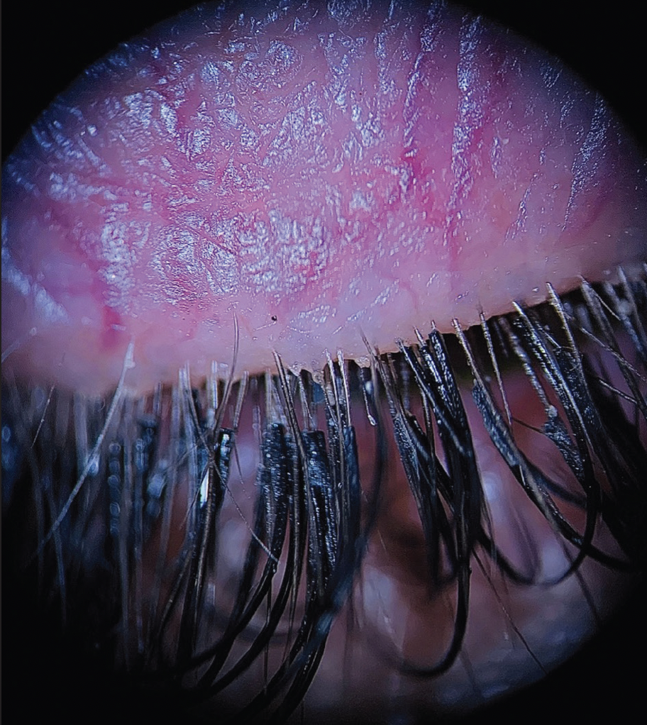 Managing Demodex Blepharitis in Eyelash Extension Wearers