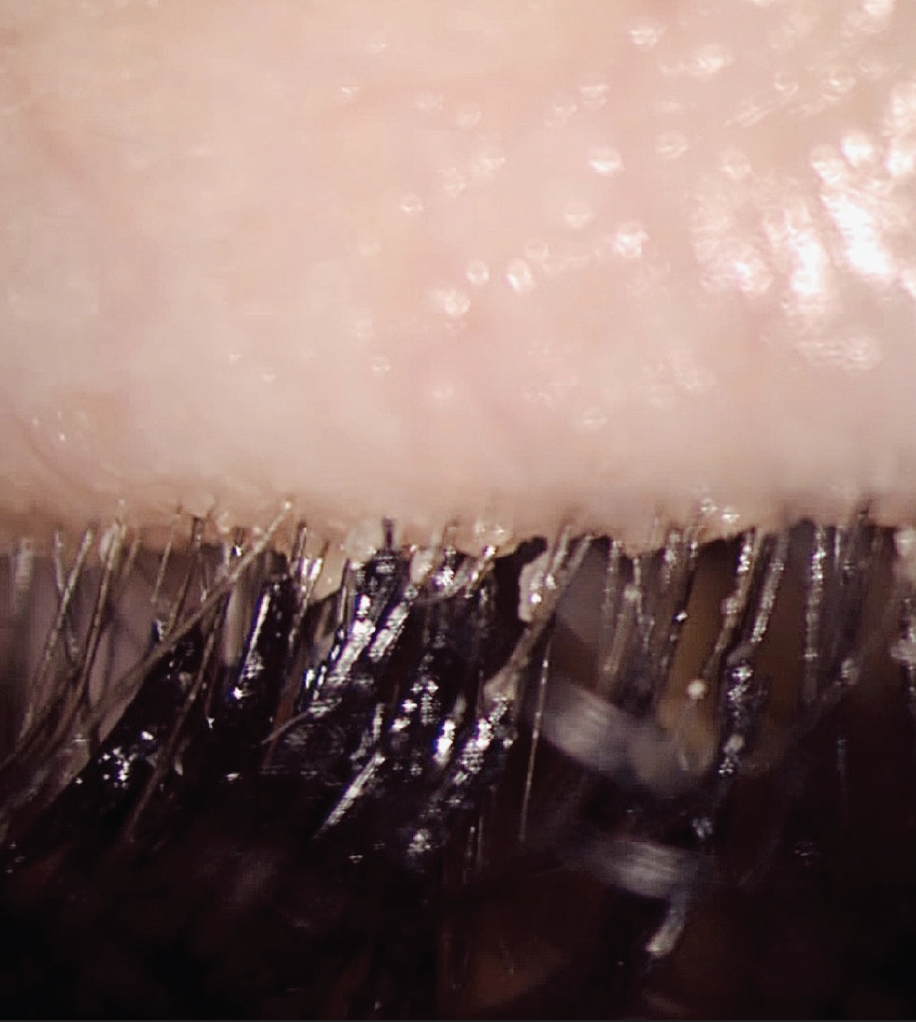 Managing Demodex Blepharitis in Eyelash Extension Wearers