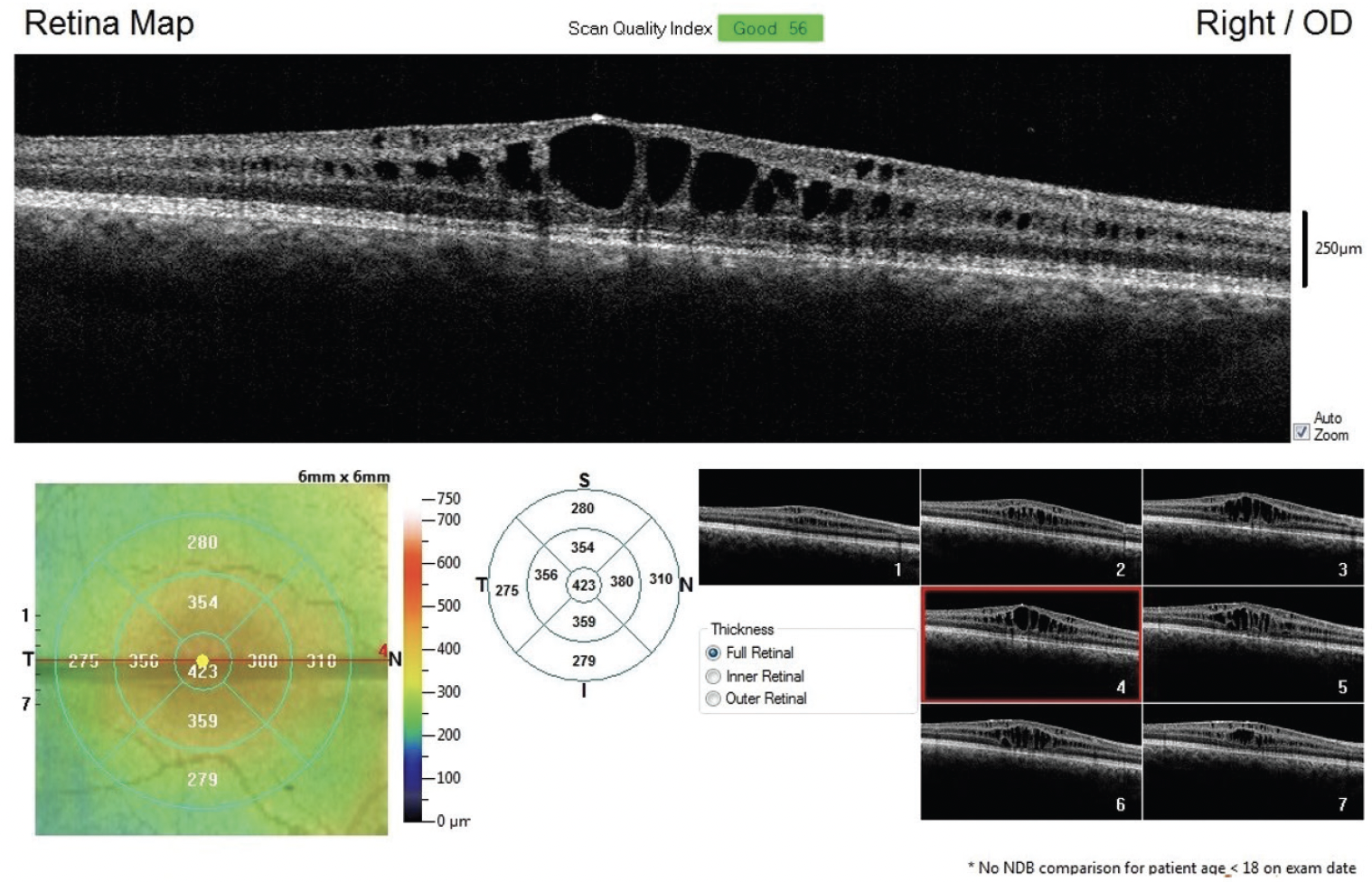 Lickety-Split Retina