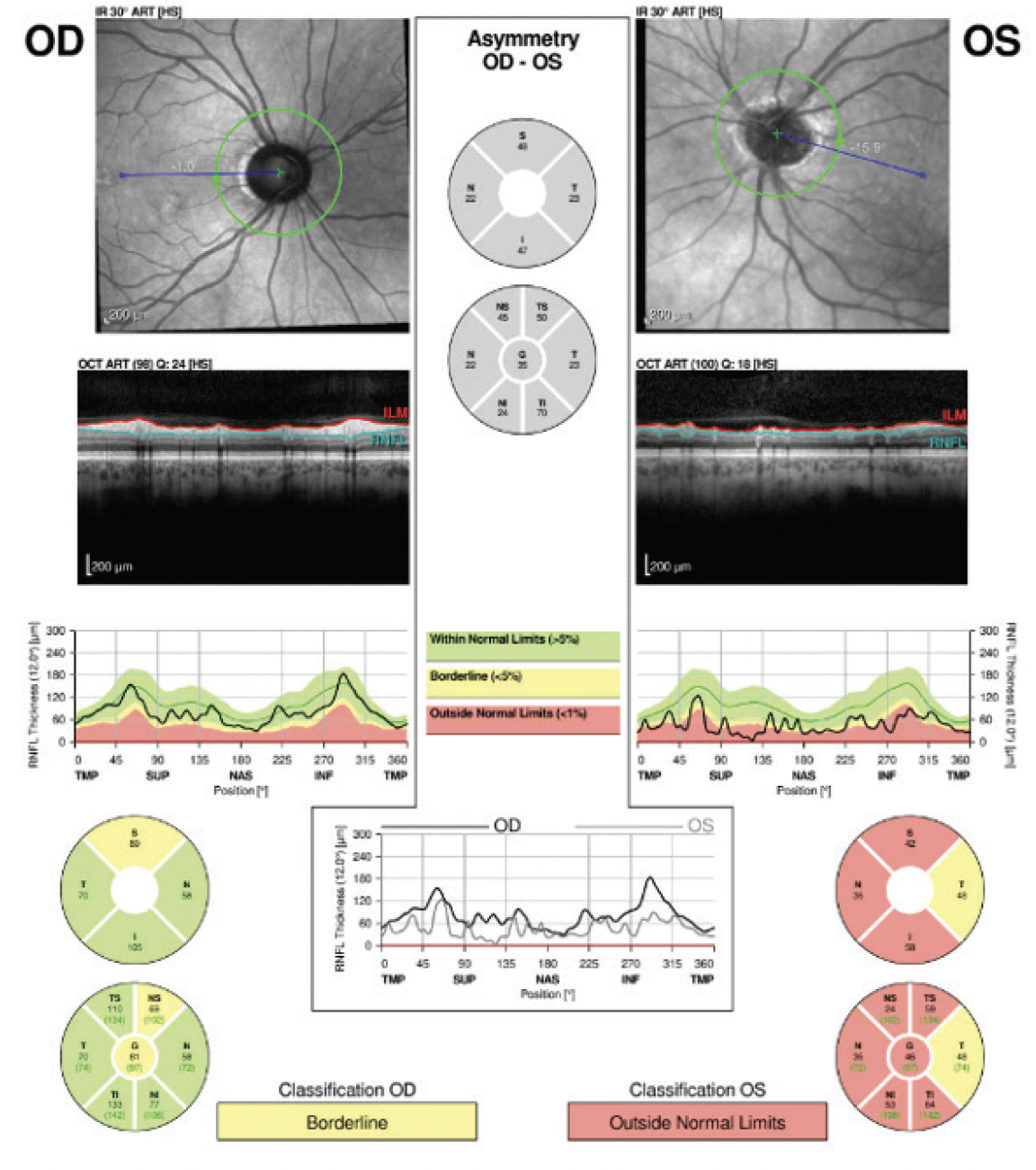 Rationalizing the Red: When RNFL Atrophy Is Not Glaucoma