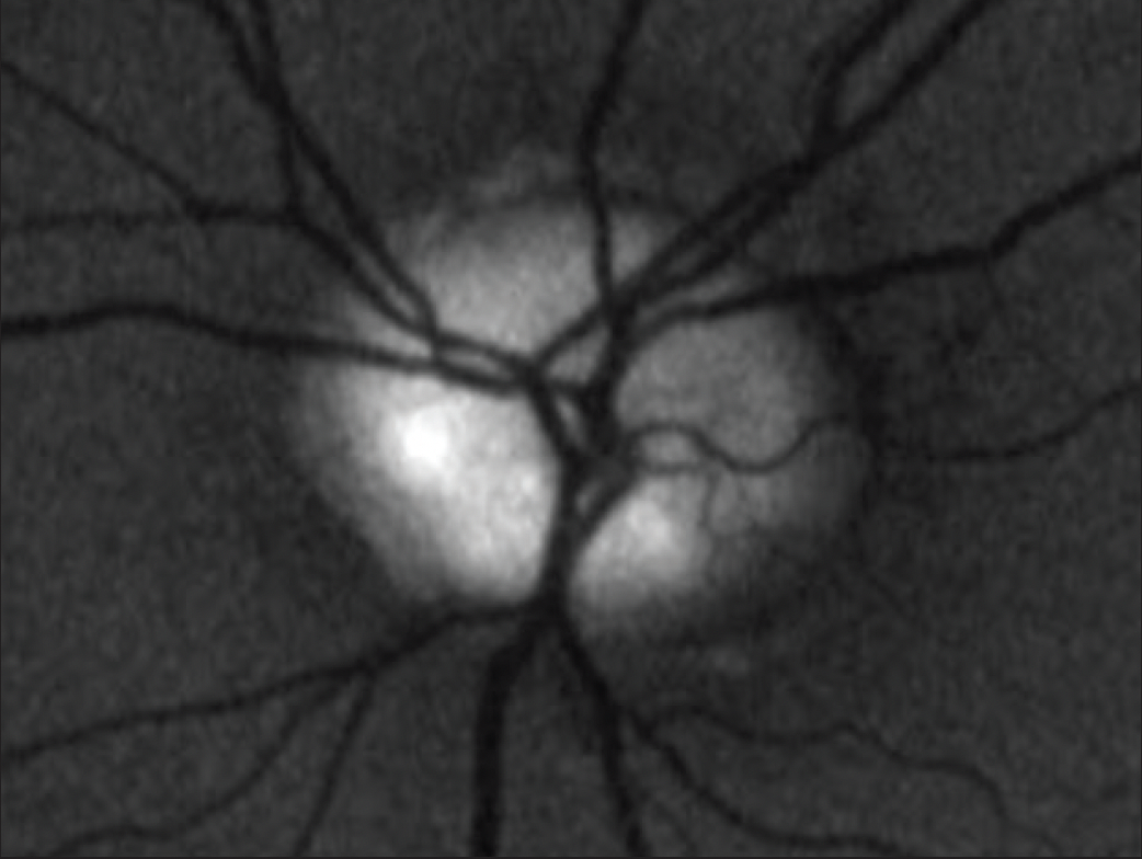 Rationalizing the Red: When RNFL Atrophy Is Not Glaucoma