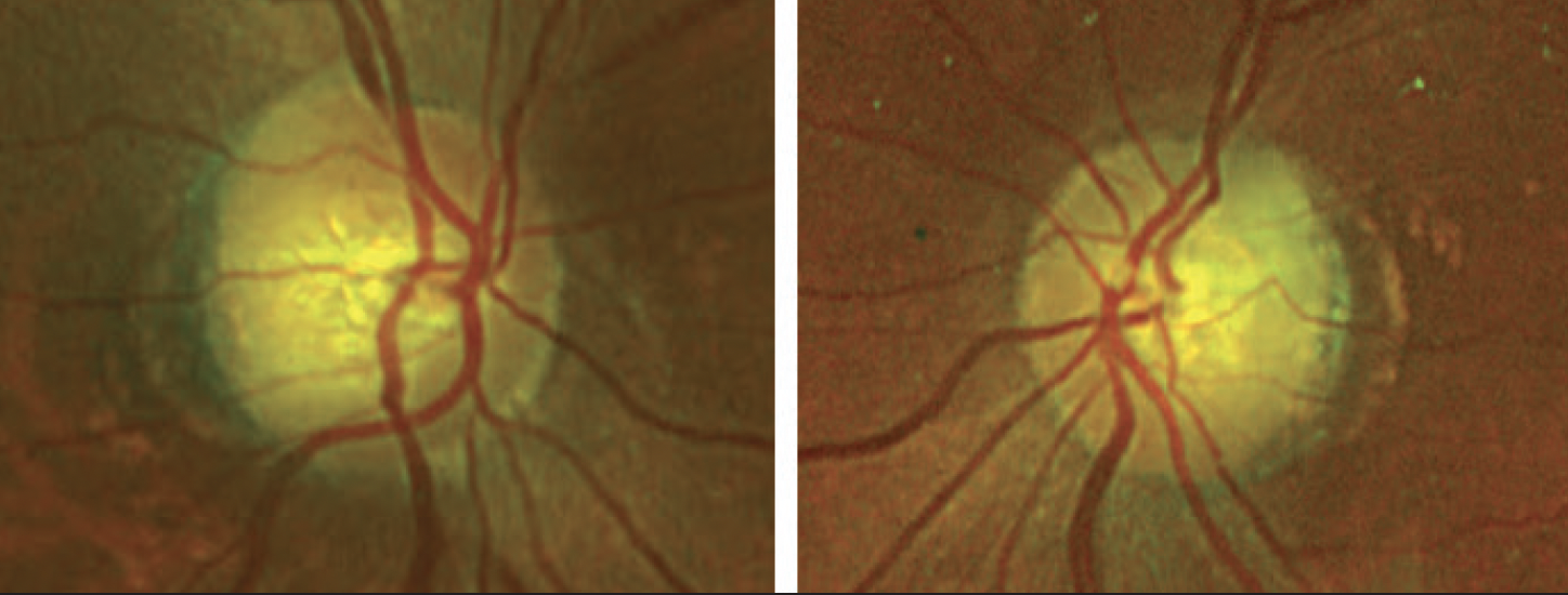 Rationalizing the Red: When RNFL Atrophy Is Not Glaucoma