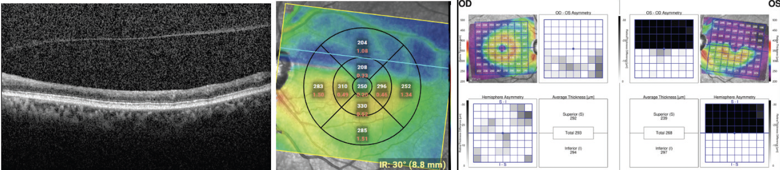 Rationalizing the Red: When RNFL Atrophy Is Not Glaucoma