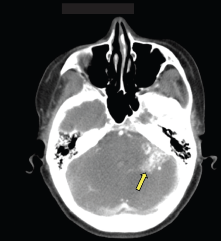 Foville Syndrome Associated With Cerebellar Arterioven...