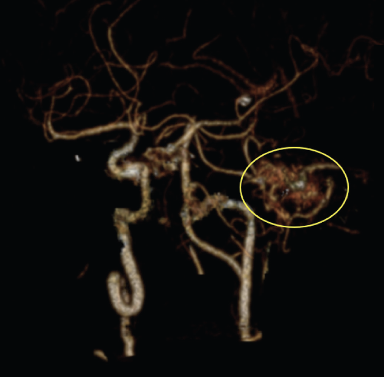 Foville Syndrome Associated With Cerebellar Arterioven...