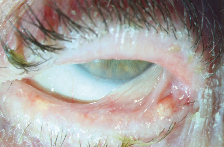 Managing Ocular Cicatricial Pemphigoid-Related OSD