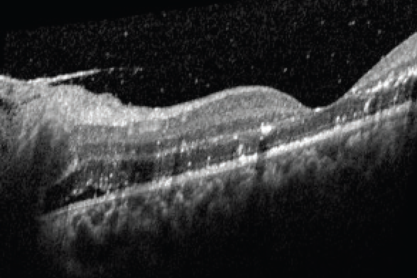 Neuroretinitis From Cat Scratch Disease