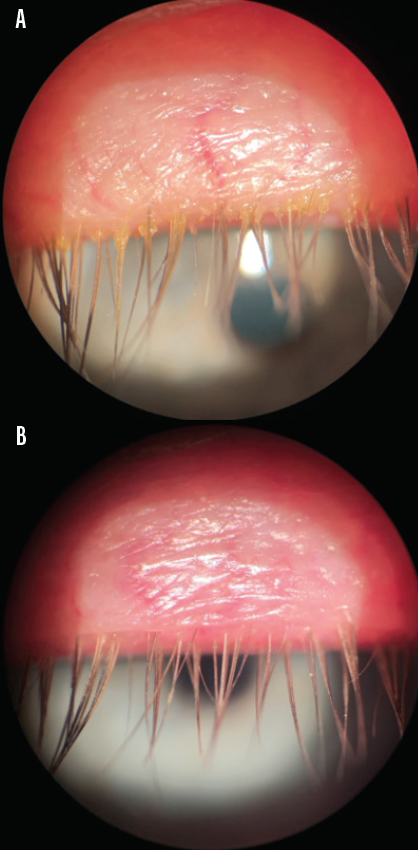 A Guide to Managing Blepharitis