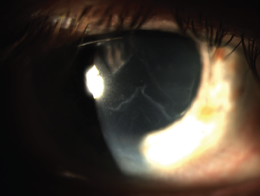 Identifying and Managing Corneal Dystrophies