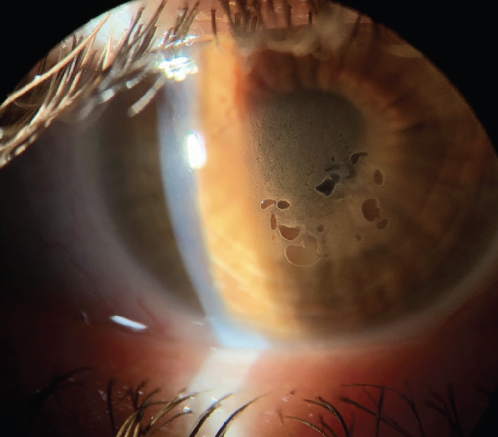 The Optometrist’s Guide to Fuchs Endothelial Corneal D...