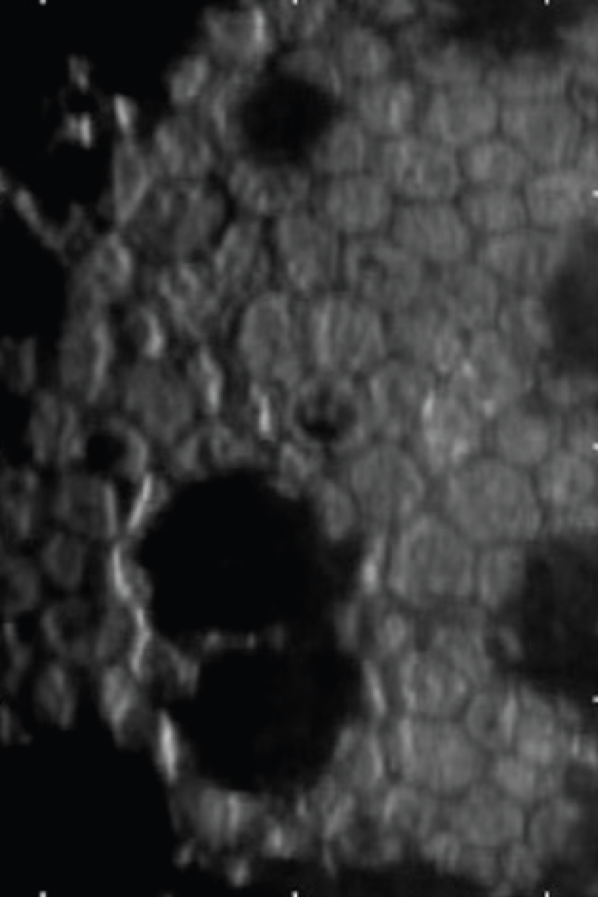 Corneal Endothelial Disease Intervention