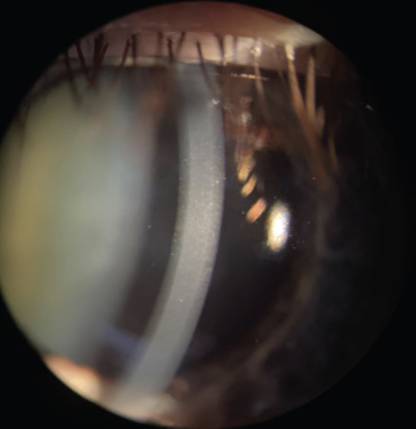 Corneal Endothelial Disease Intervention