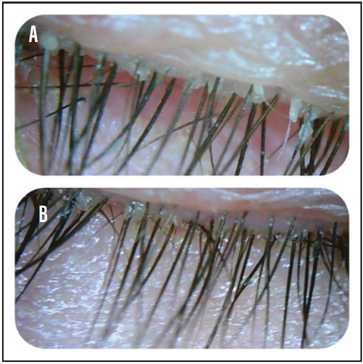 A Primer on Demodex Blepharitis