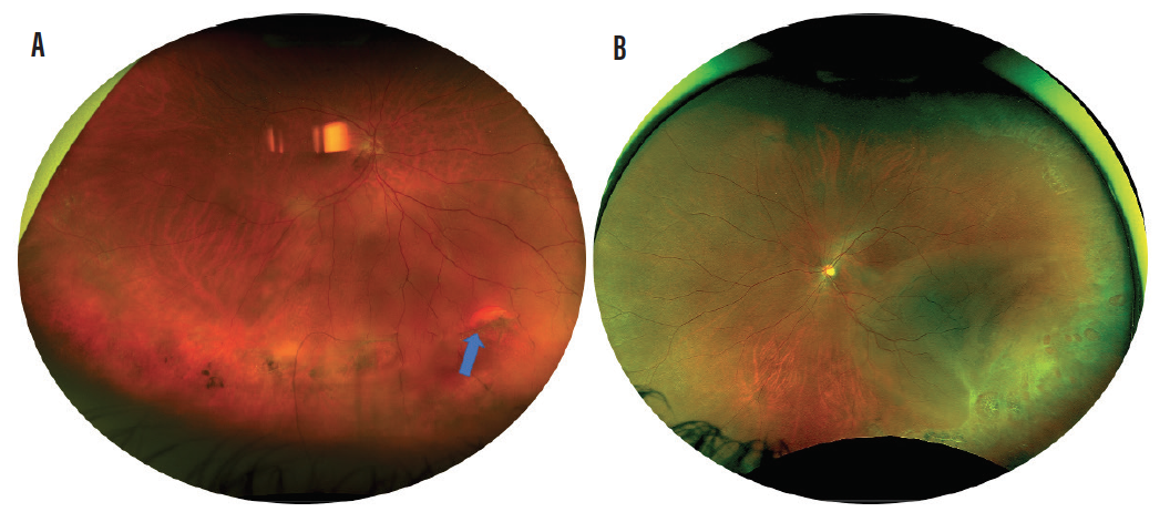 The Usual (Retina) Suspects