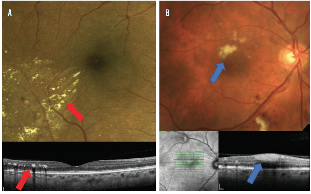 The Usual (Retina) Suspects