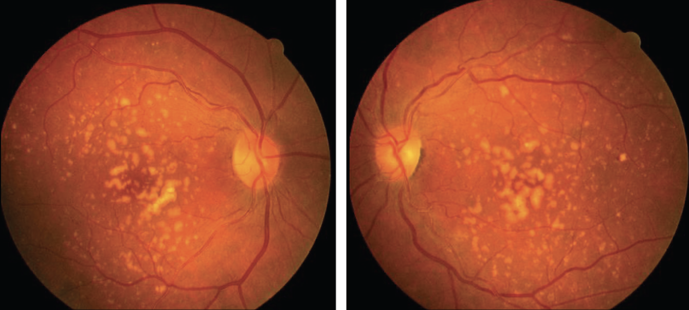 The Role Of The Complement Pathway In Amd 6103