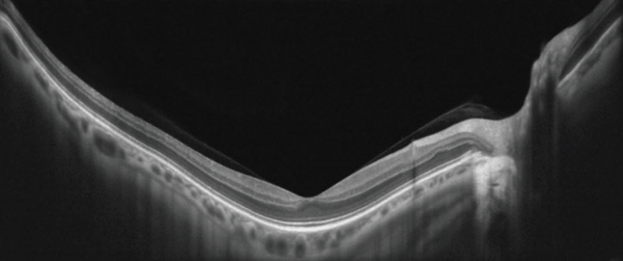Know Your Vitreomacular Interface Disorders