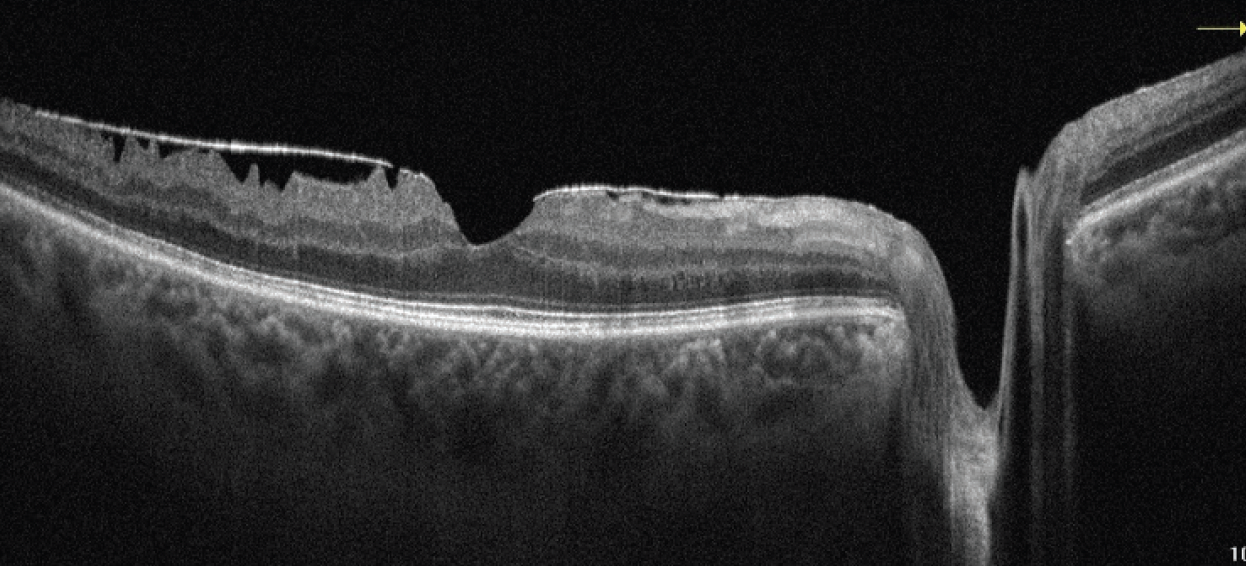 Know Your Vitreomacular Interface Disorders