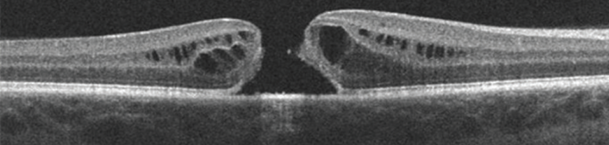 Know Your Vitreomacular Interface Disorders