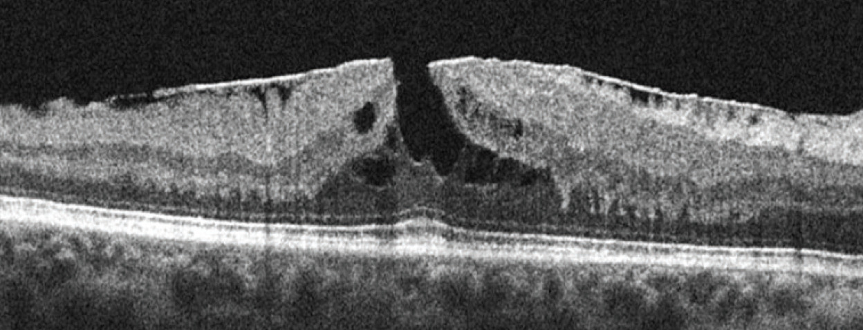 Know Your Vitreomacular Interface Disorders
