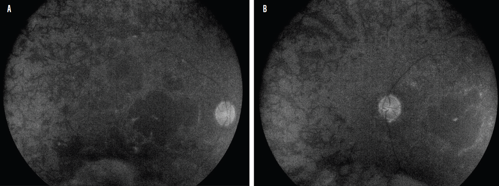 Managing a Case of Retinitis Pigmentosa
